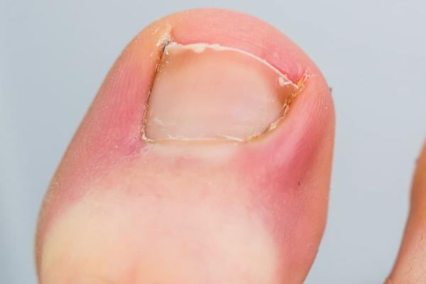 Hangnail toe store
